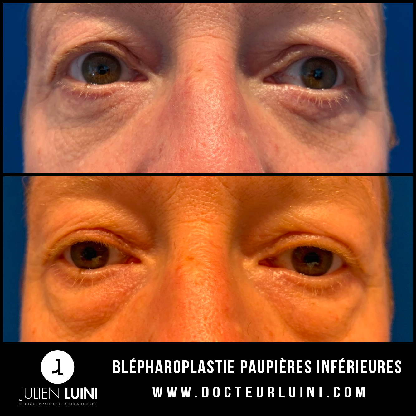 Blépharoplastie en images Chirurgie esthétique des paupières
